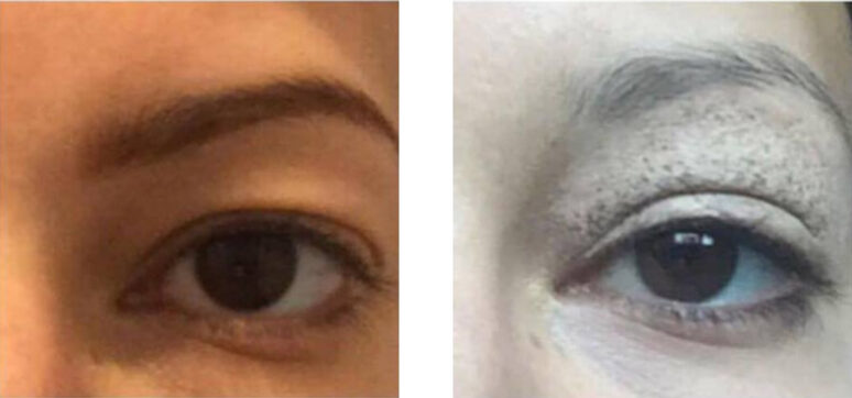 Plexr Plasma Soft Surgery - Essex Private Clinic